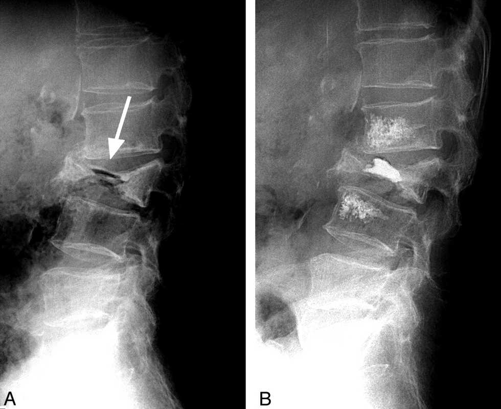 After Breaking My Back I Woke Up To The Desire To Be Better Every Day ...