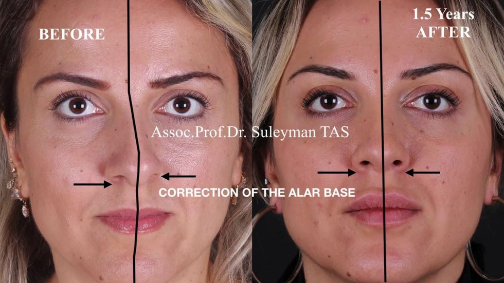 Nose Collapse After Rhinoplasty | The Odyssey Online