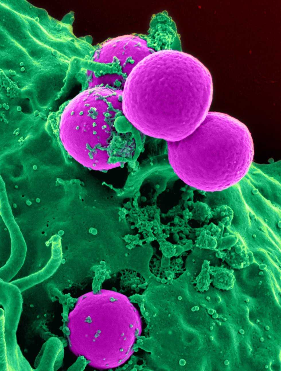 Superbugs Are Real, And They Are Coming For Us | The Odyssey Online